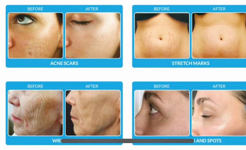 Procell MD System | Smooth Reflections Skincare and Waxing Studio